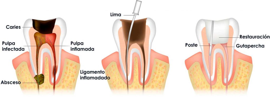 Endodoncia en Costa Rica: Tratamiento de Nervio